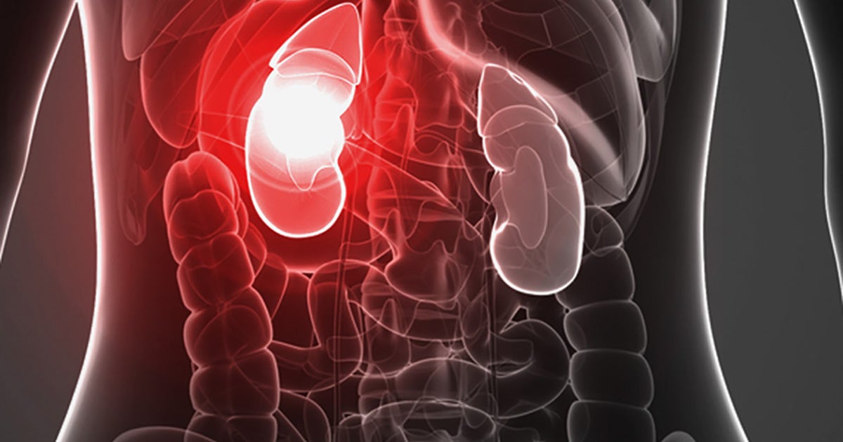 4 Ways to Protect Your Single Kidney | National Kidney Foundation