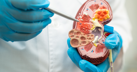 Glomerulonephritis | National Kidney Foundation
